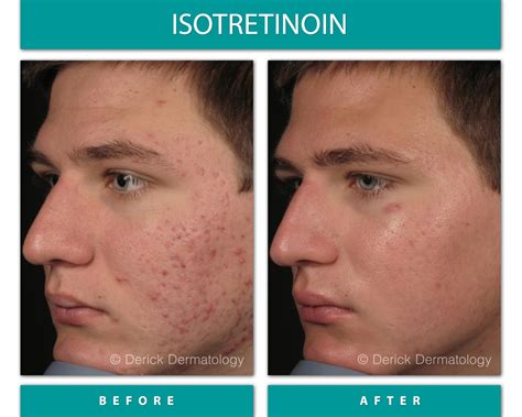 Before And After Gallery Acne Derick Dermatology