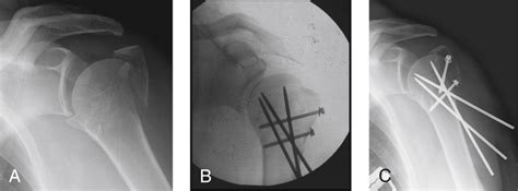 Percutaneous Pinning Of Proximal Humerus Fractures Musculoskeletal Key