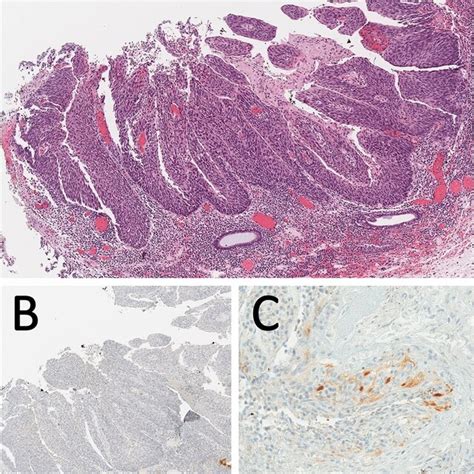 Sections From The Neck Mass Revealed Nonkeratinizing Squamous Cell Download Scientific Diagram