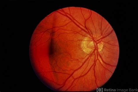 Amn Macular Neuroretinopathy Retina Image Bank