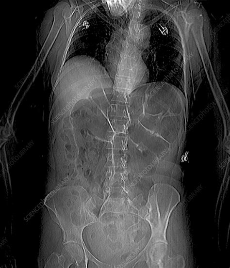 Intestinal Gas And Swollen Abdomen Ct Scan Stock Image C0370738