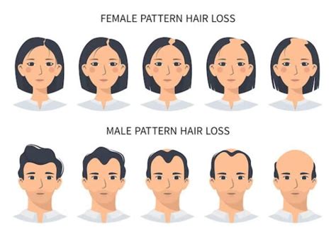 Androgenetic Alopecia Male Female Pattern Baldness Hairfree Hairgrow