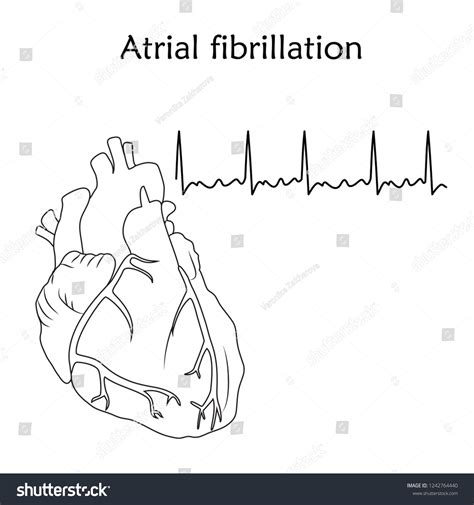 Human Heart Atrial Fibrillation Anatomy Flat Stock Vector Royalty Free