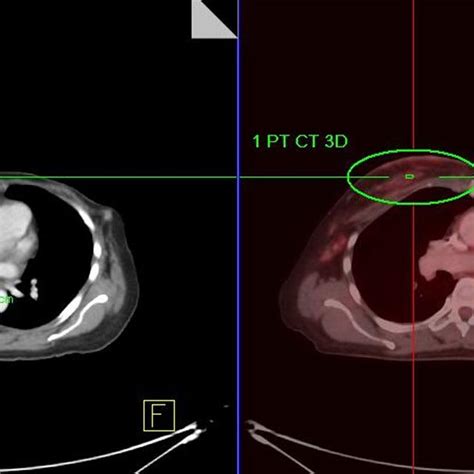 Forty Five Year Old Female History Of Left Mastectomy With Suspicious