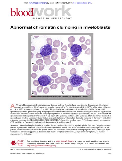 Pdf Abnormal Chromatin Clumping In Myeloblasts