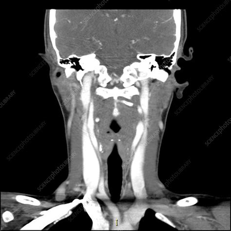 Lingual Thyroid Ct Scan Stock Image C027 1862 Science Photo Library