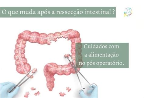 Você Sabe O Que é Uma Ressecção Do Intestino