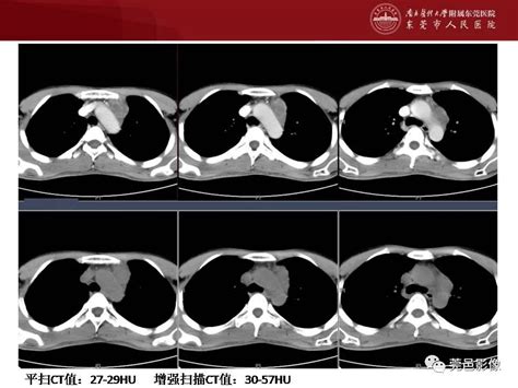 马尔尼菲蓝状菌感染影像学表现 医学界 助力医生临床决策和职业成长