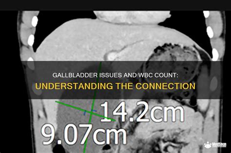 Gallbladder Issues And Wbc Count Understanding The Connection Medshun