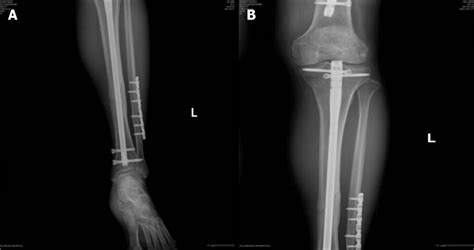 X Ray Images Of The Patient S Left Proximal Tibia A Antero Posterior
