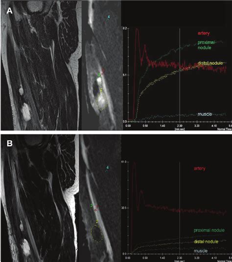 Chemotherapy Monitoring With Dynamic Contrast Enhanced Dce Mri A