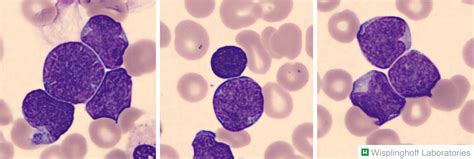Acute Myelomonocytic Leukemia