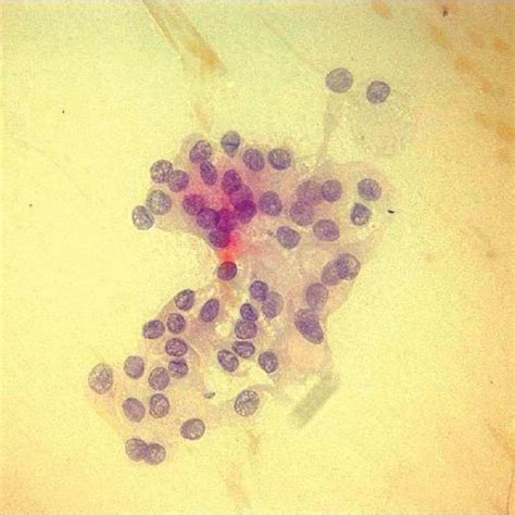 Fnac Showing Polyhedral Cells With Distinct Cells Borders Nuclei And