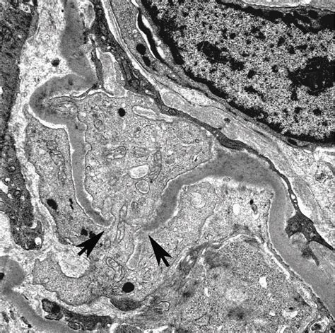 Pathology Outlines Crescentic Glomerulonephritis Overview 56 Off
