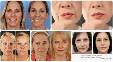 Marionette Lines Botox Before And After Results