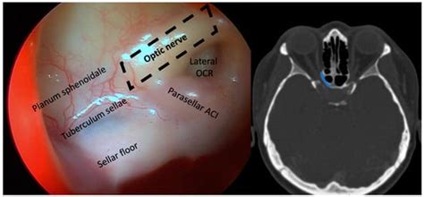 Medicina Free Full Text Does Endoscopic Transnasal Optic Nerve Decompression Followed By
