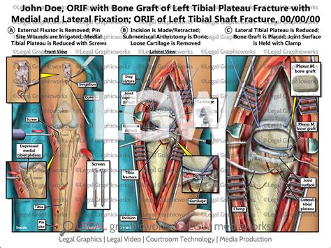 Orif With Bone Graft Of Left Tibial Plateau Fracture With Medial And L Lgwgo