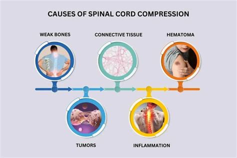 Spinal Cord Compression Nurses Revision