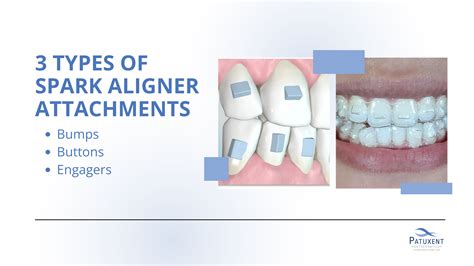 The Role Of Spark Aligner Attachments In Orthodontic Care