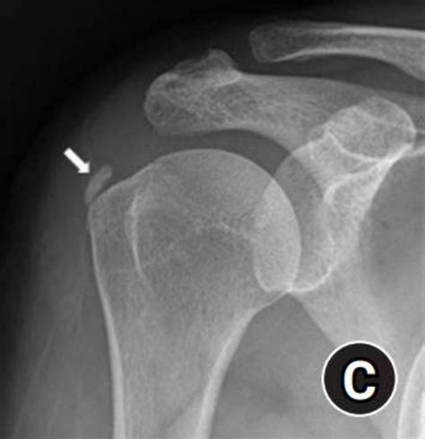 Too Much Calcium In My Tendon Understanding Calcific Tendonitis