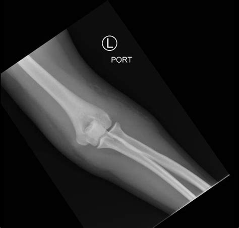 Posterior Elbow Dislocation JETem