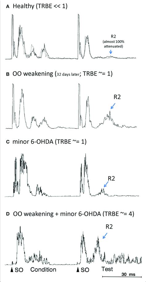 Orbicularis Oculi Emg Responses To Paired Pulse Stimulations