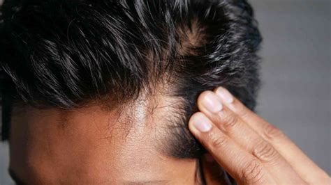 Can Drinking Alcohol Cause Hair Loss Are They Connected