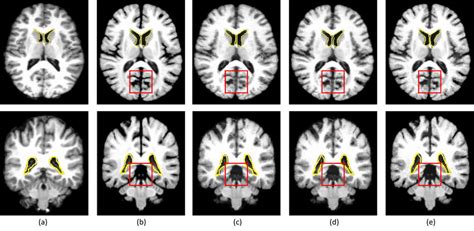comparison of sample mri slices for various experiments a moving