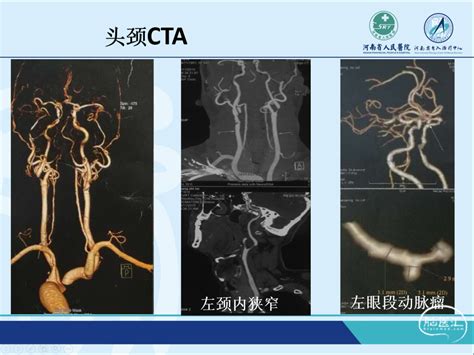 【会议预热】河南省桡动脉入路神经介入诊疗规范化培训班启动在即 脑医汇