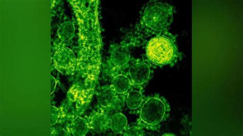 18 Year Old Girl Dies Of Nipah Virus In Malappuram Kerala Woman Found Infected In Palakkad