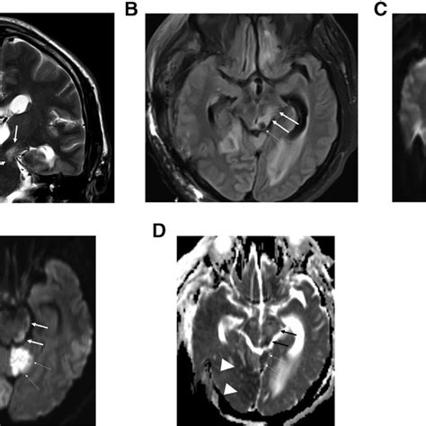 Case 1 Noncontrast Ct Scan Of The Head With A Large Acute Right Middle