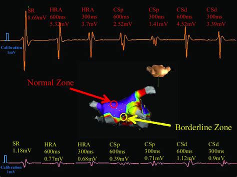 Representative Electrograms In A Patient With Persistent Atrial Download Scientific Diagram