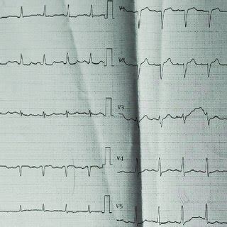 Initial Electrocardiogram At The Emergency Department After Hours Download Scientific