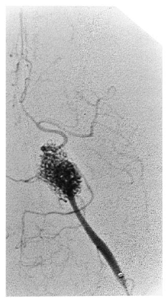 Selective Left Ascending Pharyngeal Angiogram Dem Onstrating The
