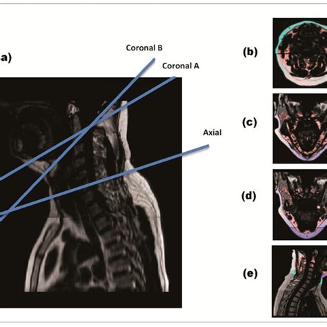 Mri Of Cervical Subcutaneous Adipose Tissue Four Anatomical Slices Per