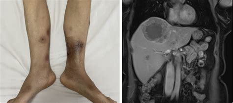 Клиничен случай паникулит поради карцином на панкреаса