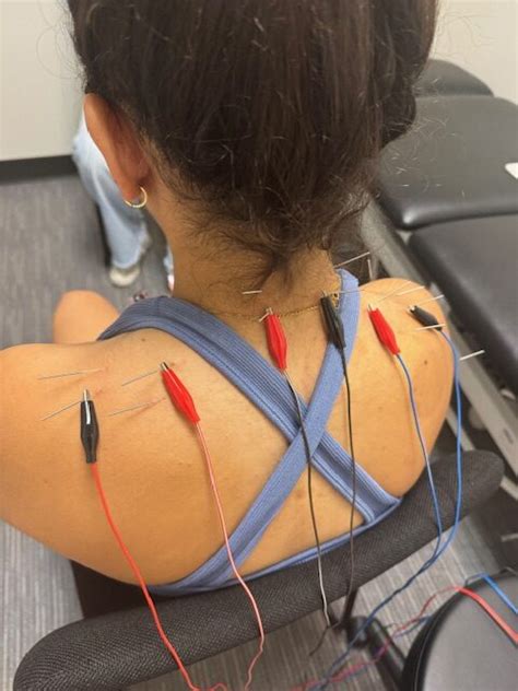 Dry Needling Spring Physical Therapy