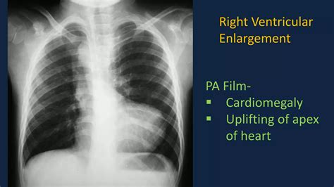 Pediatric Chest X Ray Interpretationpdf
