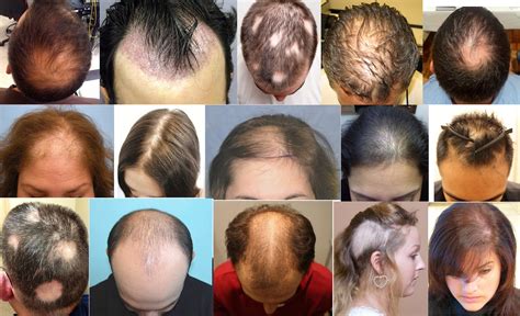 Phân biệt các mức độ rụng tóc ở nam giới Thuốc mọc tóc nhật bản