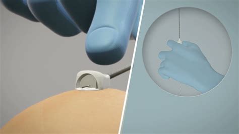 Rocket Medical Copeland Fetal Scalp Electrode Youtube