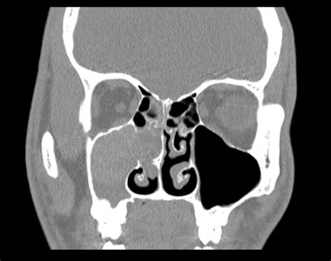 Ct Scan Extreme Sinusitis Rsinusitis