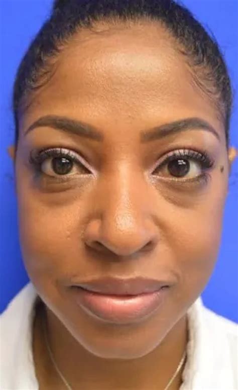Patient 814436 Lower Eyelid Before And After Photos Muse Plastic Surgery
