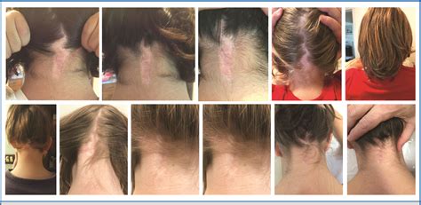 Figure 3 From The “three On A Stick” Incision—a Curvilinear Solution For The Occipital And