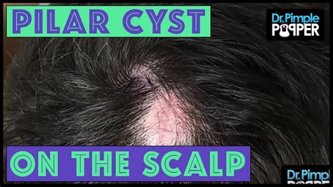 Another One Three Pilar Cysts Removed Youtube