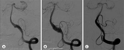 Serial Angiogram Of The Left Va A Initial Angiogram Showing A Left