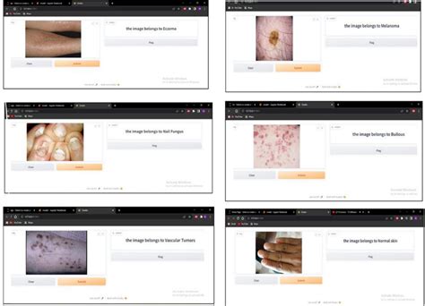 Figure 4 Enhanced Skin Disease Detection And