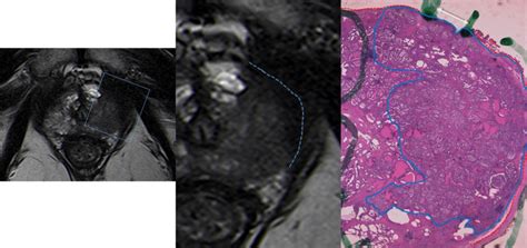 Radiologic Pathologic Correlation Of Prostatic Cancer Extracapsular