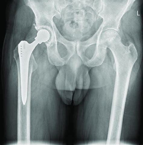 X Ray After Cup Revision 2014 Download Scientific Diagram