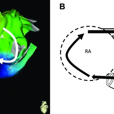 A Activation Map Of The Biatrial Flutter Circuit The Asterisk Denotes Download Scientific
