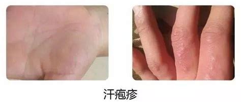 【疾病预防】一到夏天手上就长这样的小水泡，到底应该怎么做？手癣工作手掌